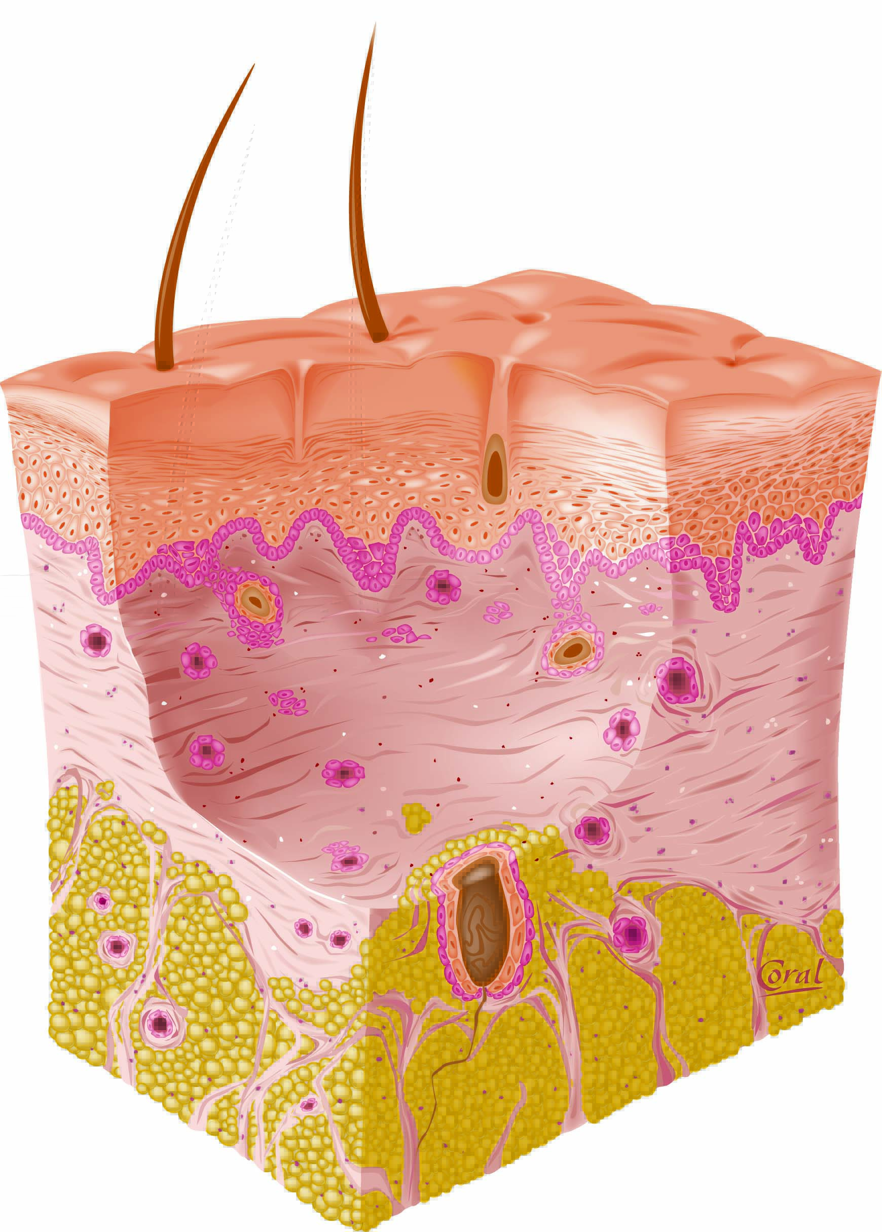 Wat zijn brandwonden en hoe ontstaan ze? · Brandwondenzorg