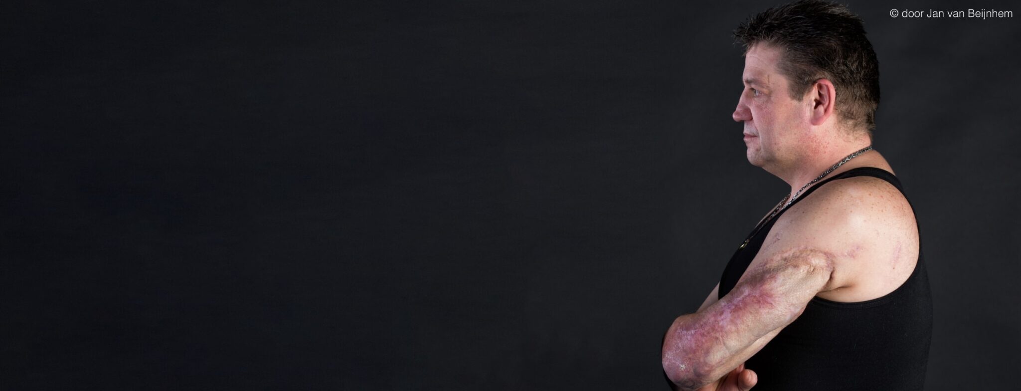 Informatie overzicht NWDI · Brandwondenzorg